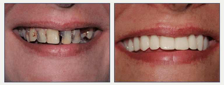 Advanced Dental Implants Plainview NY - PureDent | $3200